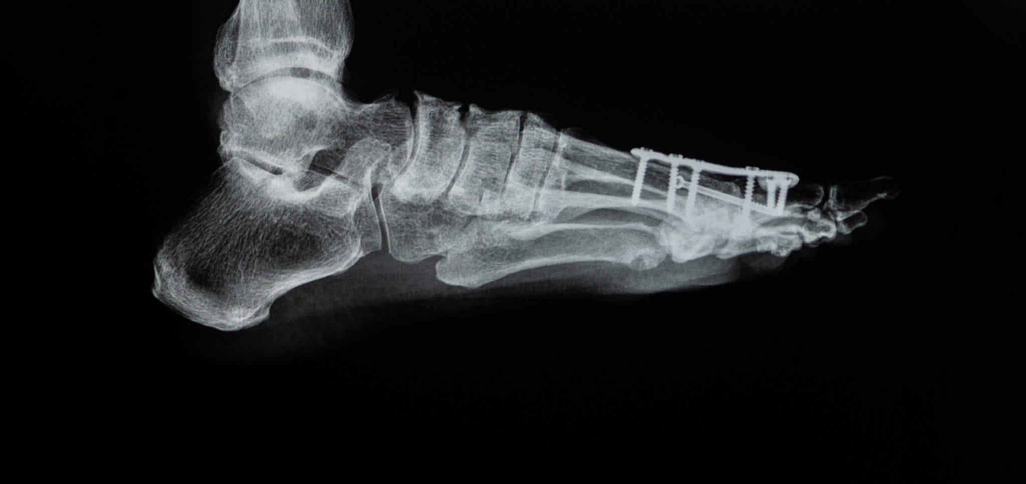 Hallux Rigidus - Dr Jeremie Knafo